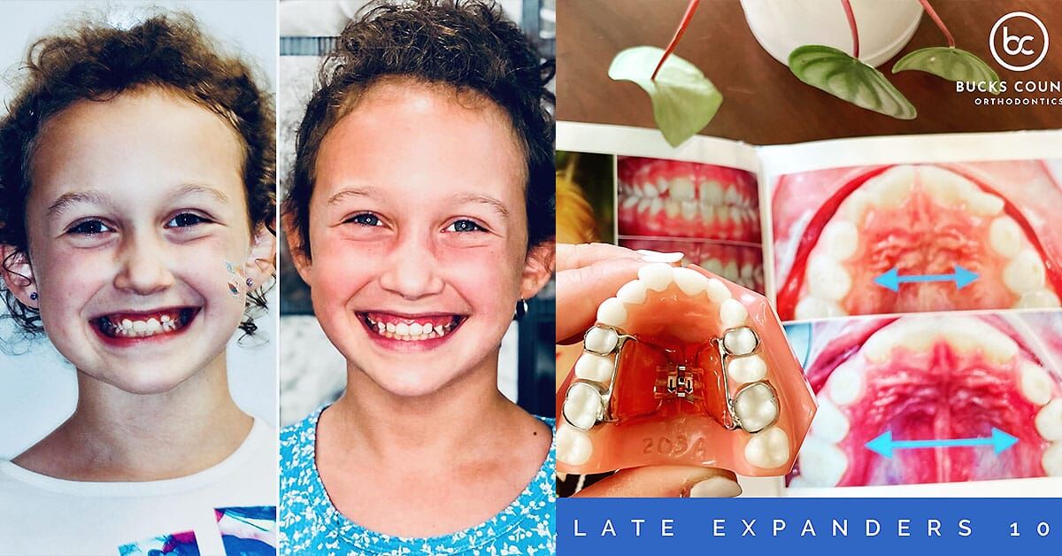 Orthodontic Expansion & Airway - What You Need To Know